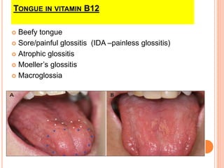 Megaloblastic anemia | PPTX