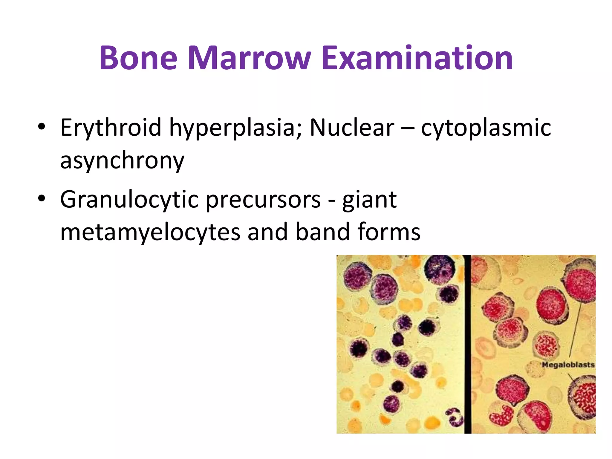 Megaloblastic anemia in childhood | PPTX