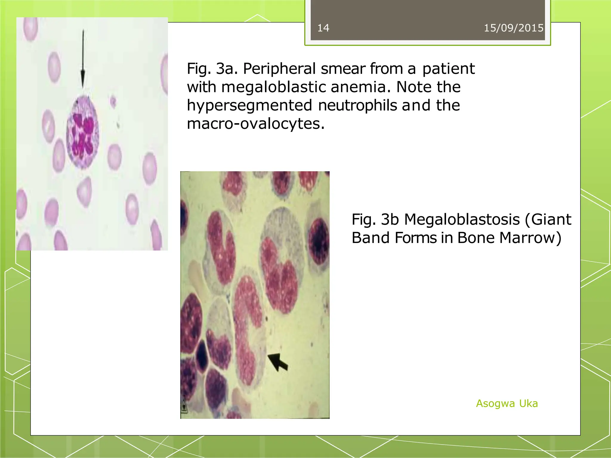 megaloblasticanemia-150915165015-lva1-app6892.pptx