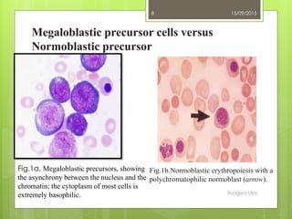Megaloblastic anemia | PPTX