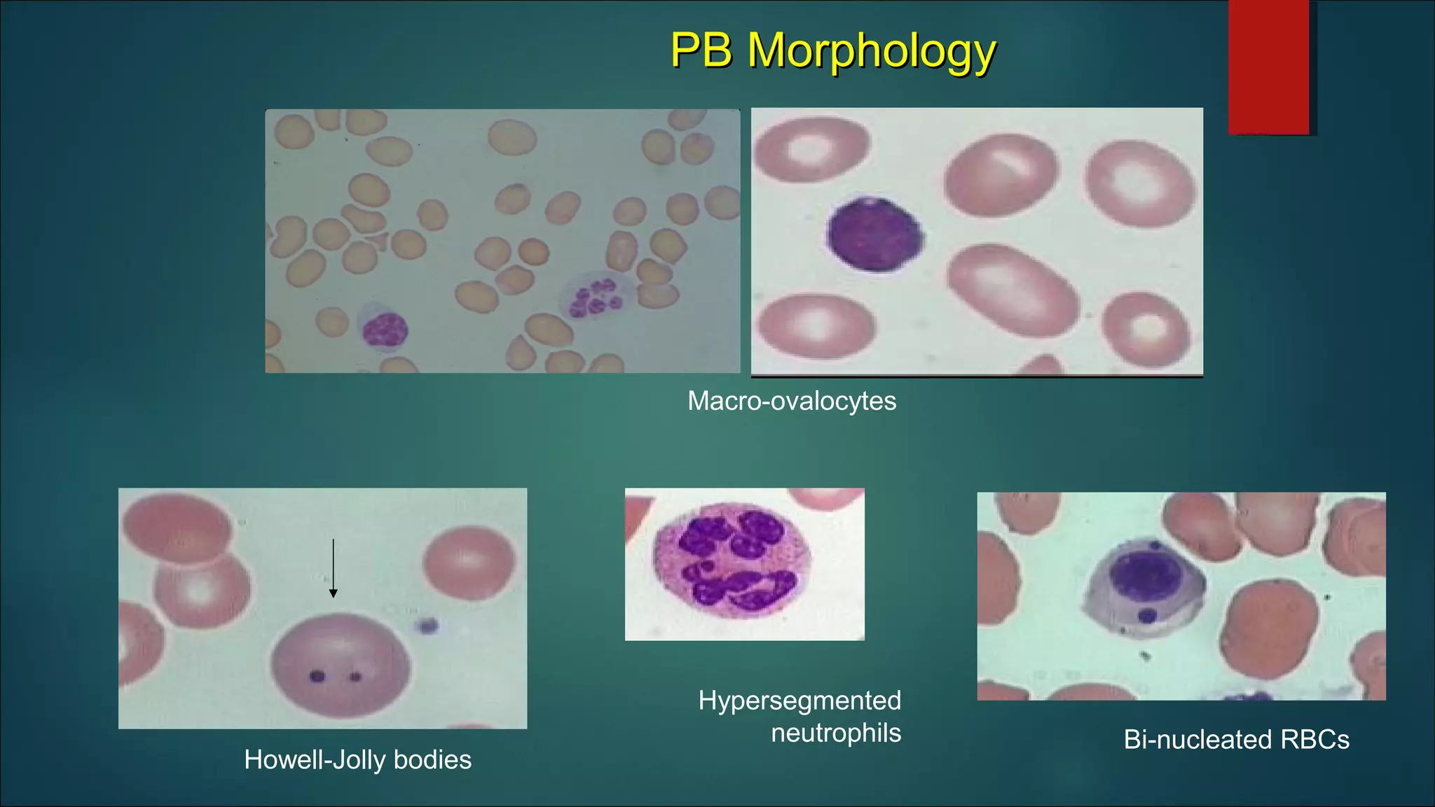 Megaloblasticanemia | PPT