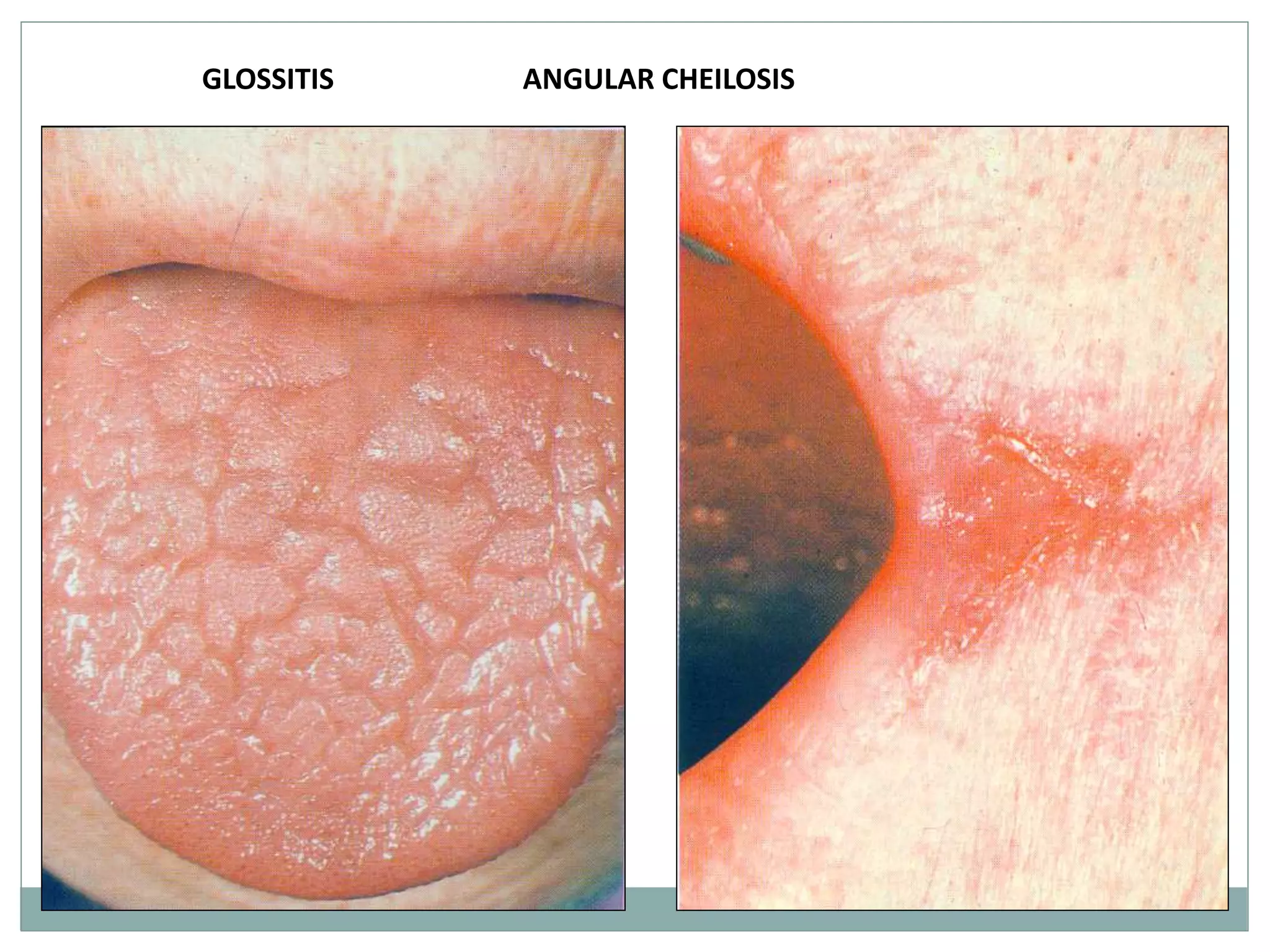 Megaloblastic anemia.pptx