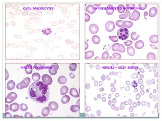 Megaloblastic anemia.pptx