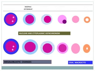 Megaloblastic anemia.pptx