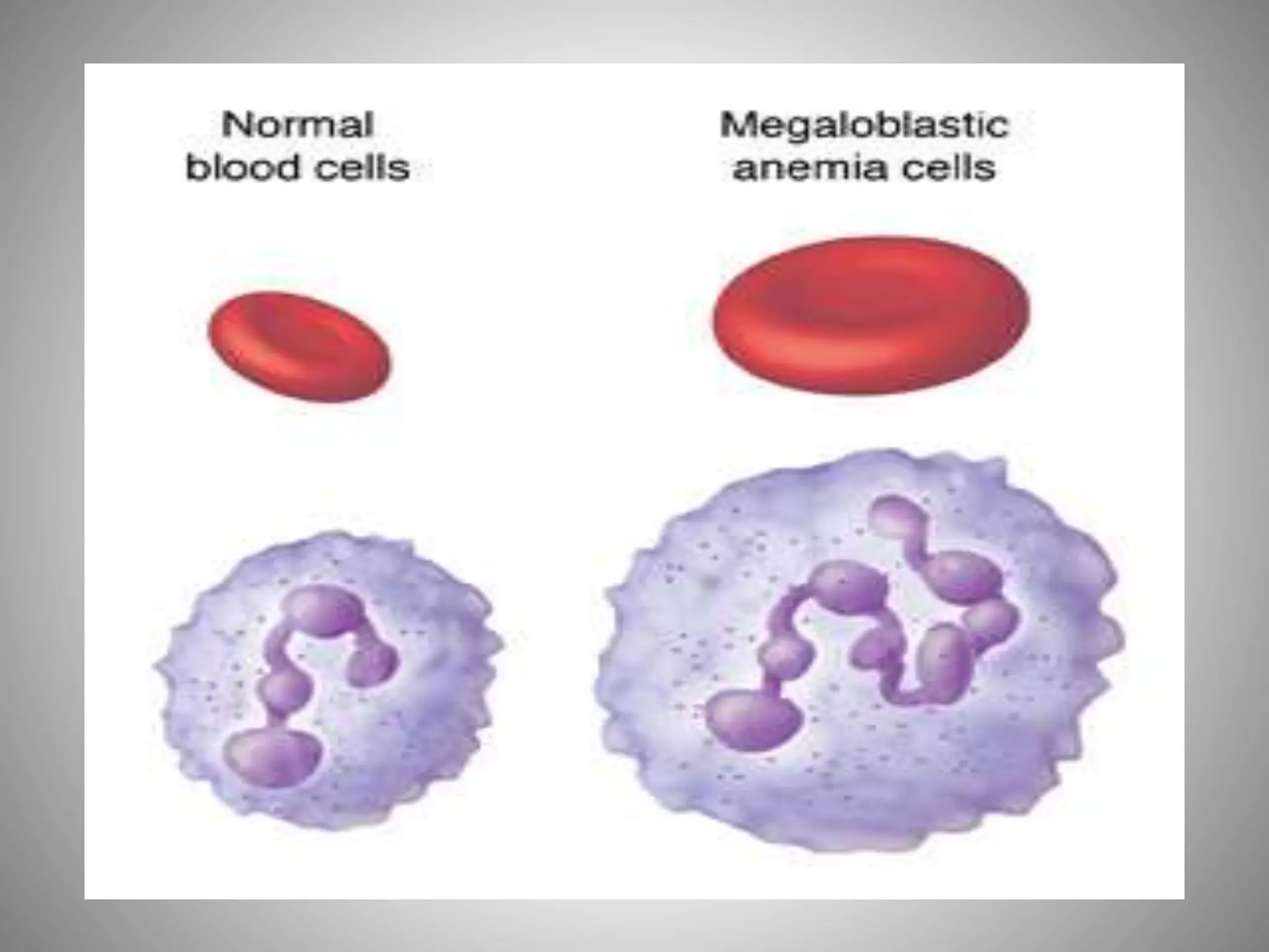 PATHOPHYSIOLOGY OF MEGALOBLASTIC ANEMIA .pptx