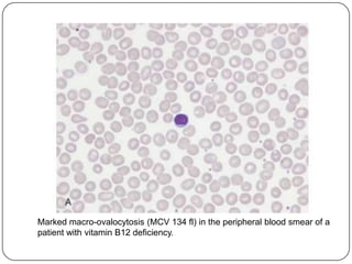 Vitamin B12 Deficiency Anemia Smear