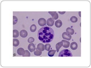 Vitamin B12 Deficiency Anemia Smear