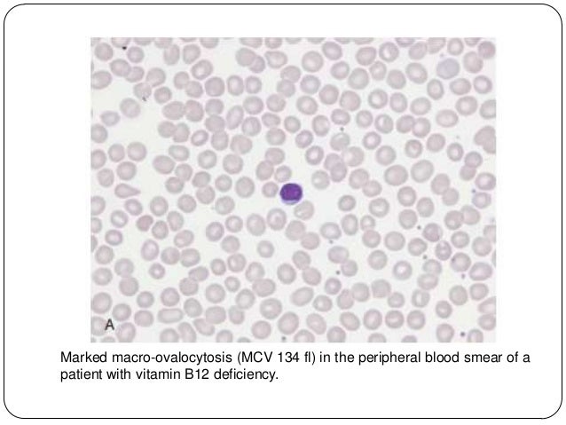 Vitamin B12 Deficiency Smear