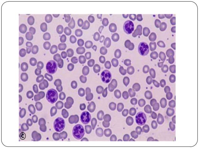 Megaloblastic Anemia Peripheral Smear