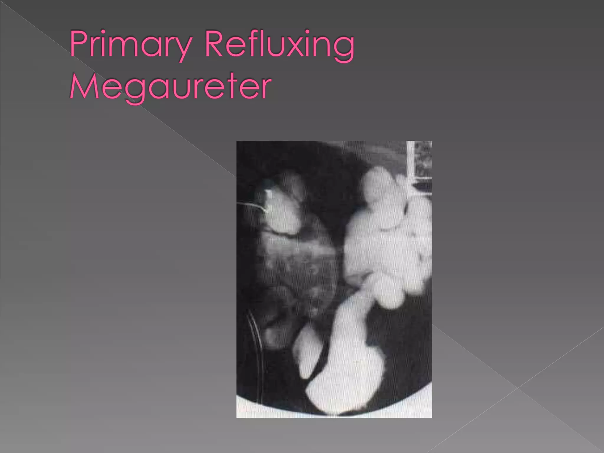 Megaureter ppt. Types, pathophysiology, evaluation and management. | PPTX