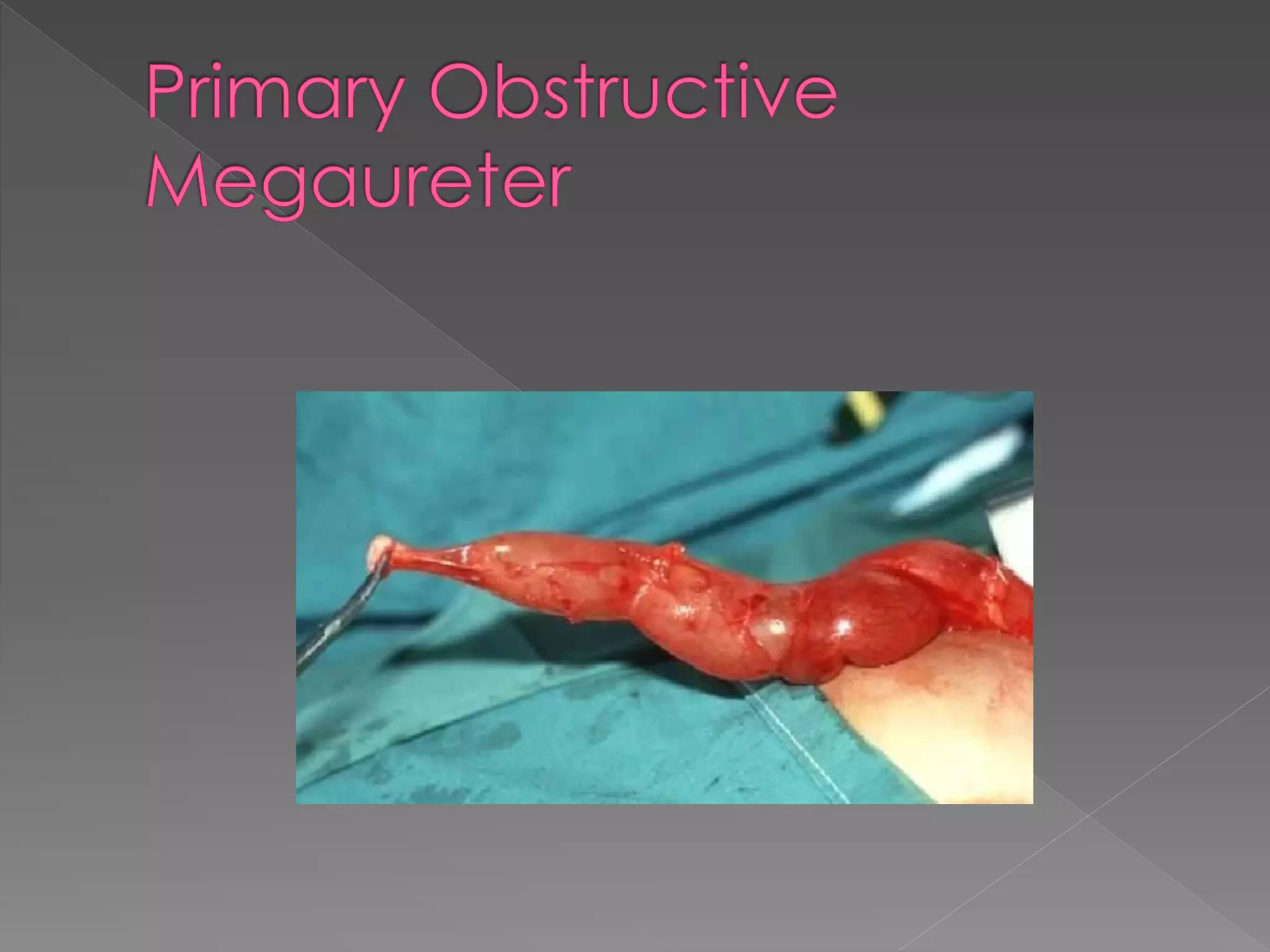 Megaureter ppt. Types, pathophysiology, evaluation and management. | PPTX