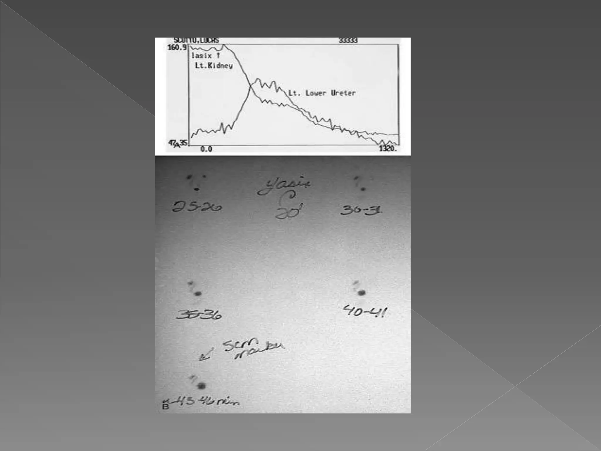 Megaureter ppt. Types, pathophysiology, evaluation and management. | PPTX