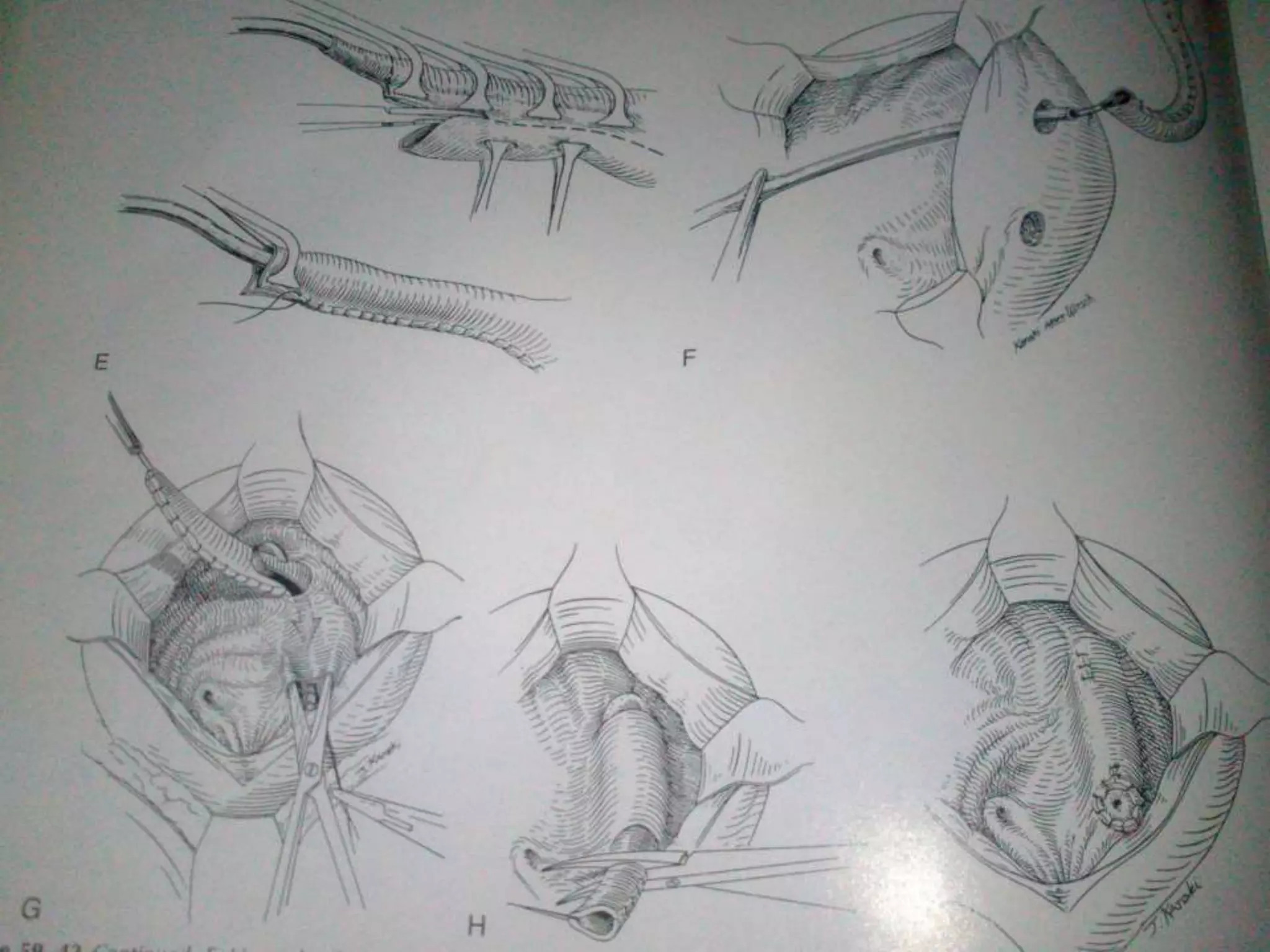 Megaureter ppt. Types, pathophysiology, evaluation and management. | PPTX