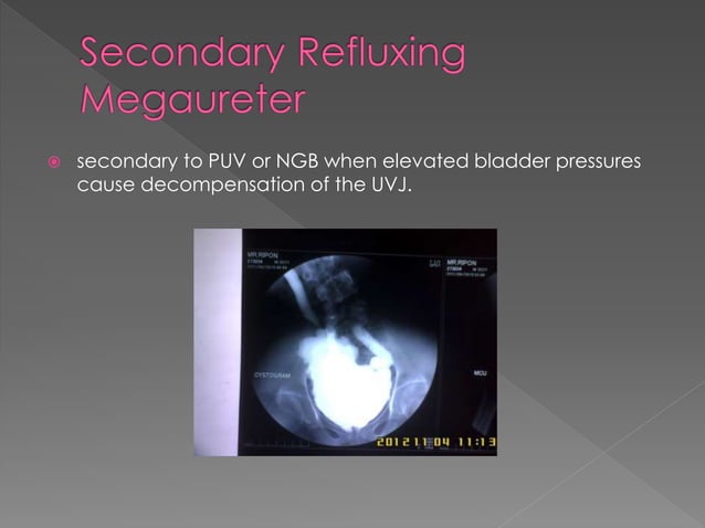 Megaureter ppt. Types, pathophysiology, evaluation and management ...