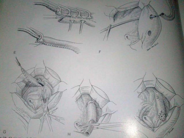 Megaureter ppt. Types, pathophysiology, evaluation and management ...
