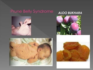 Megaureter ppt. Types, pathophysiology, evaluation and management. | PPTX