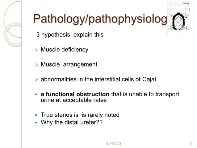 megaureter.pptx | Surgery | Medical Health