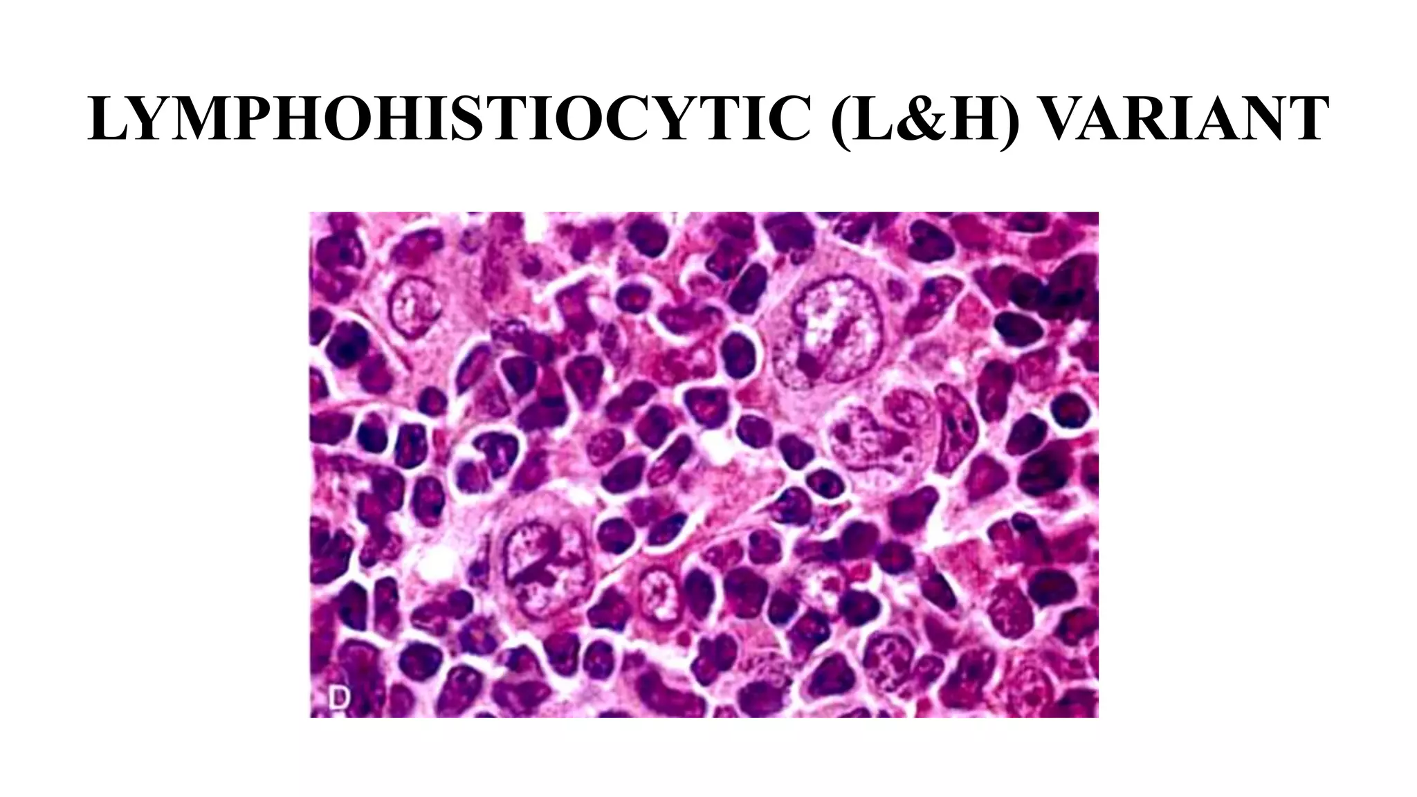 Meghana - neoplastic lesions of lymph node - part 1 | PPT
