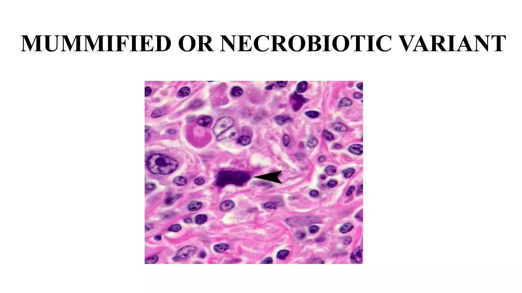 Meghana - neoplastic lesions of lymph node - part 1 | PPT