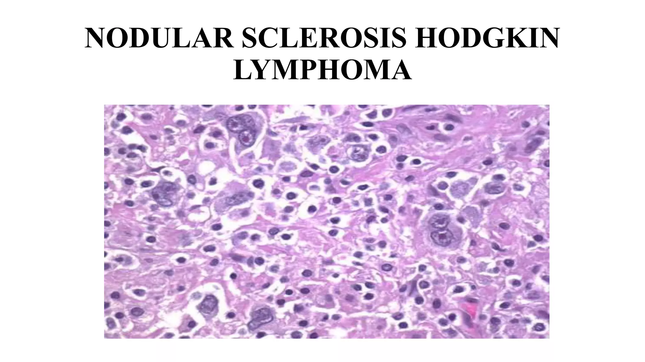 Meghana - neoplastic lesions of lymph node - part 1 | PPT