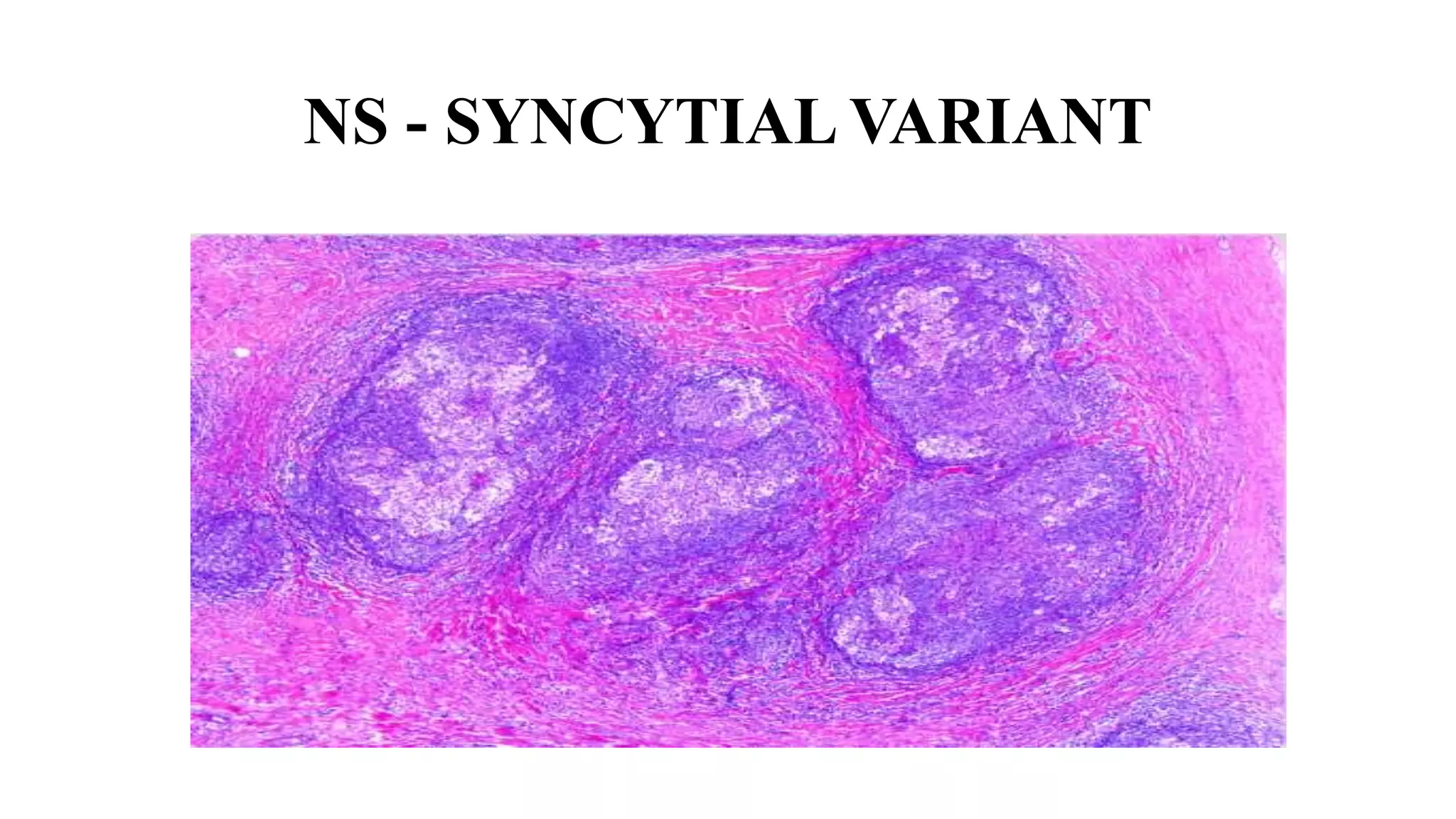 Meghana - neoplastic lesions of lymph node - part 1 | PPT