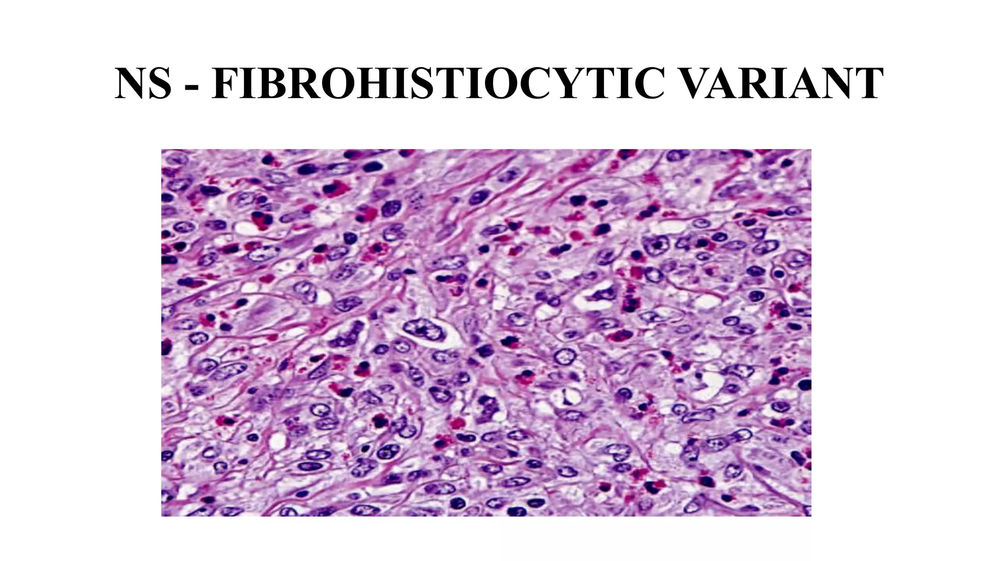 Meghana - neoplastic lesions of lymph node - part 1 | PPT