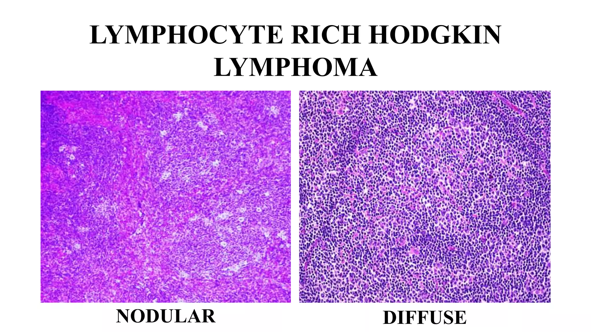 Meghana - neoplastic lesions of lymph node - part 1 | PPT