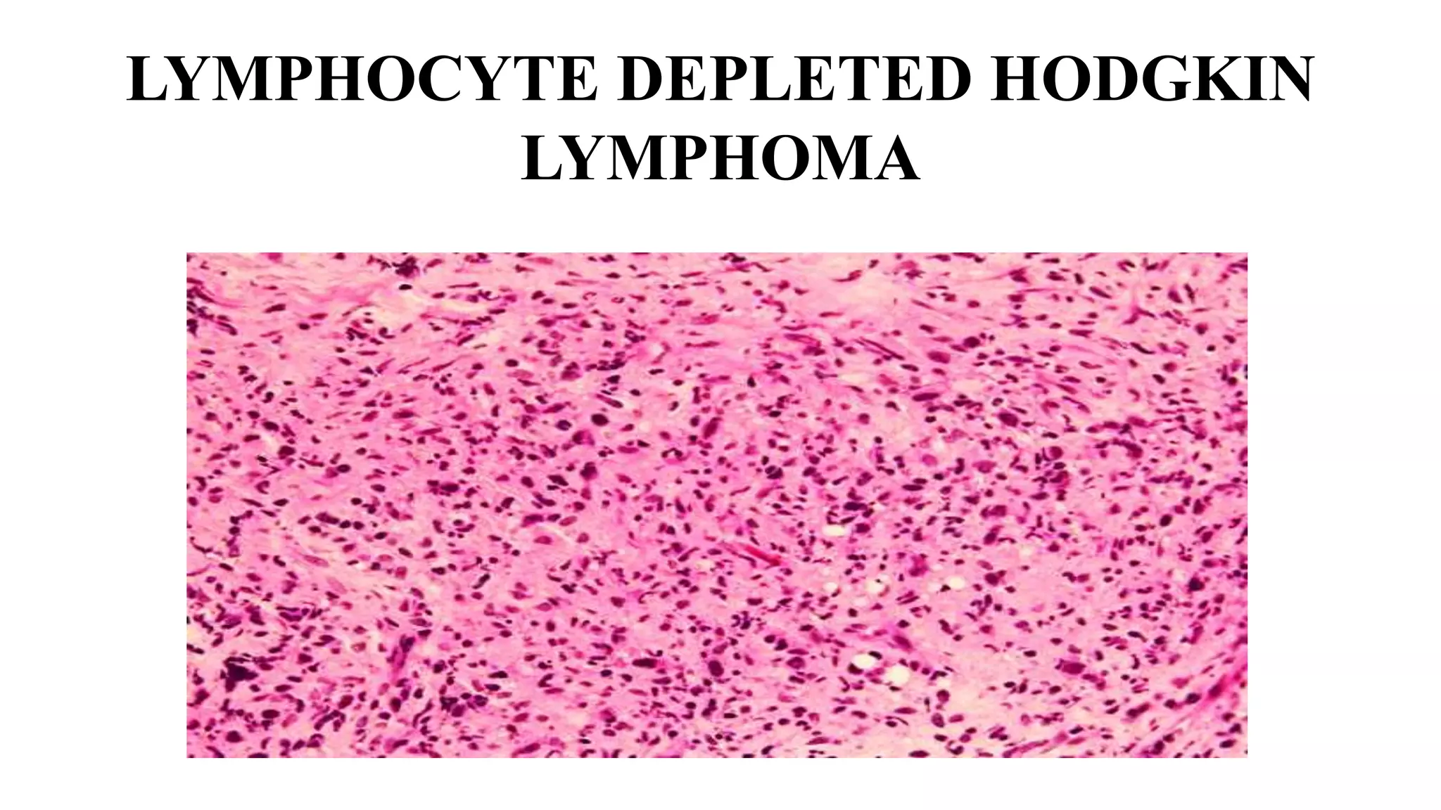 Meghana - neoplastic lesions of lymph node - part 1 | PPT