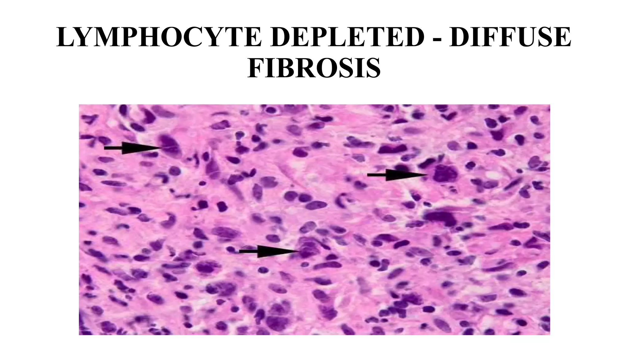 Meghana - neoplastic lesions of lymph node - part 1 | PPT