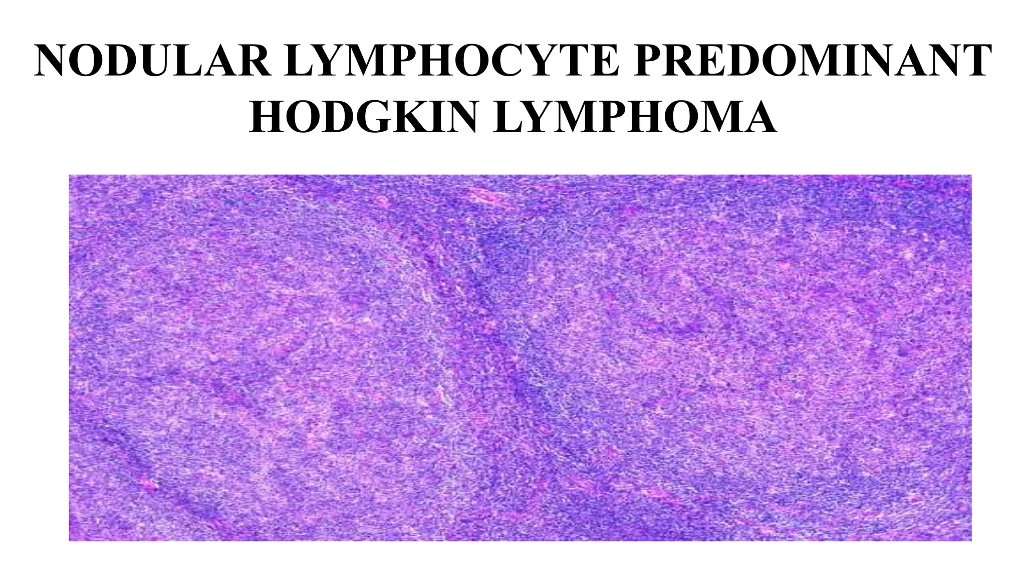 Meghana - neoplastic lesions of lymph node - part 1 | PPT