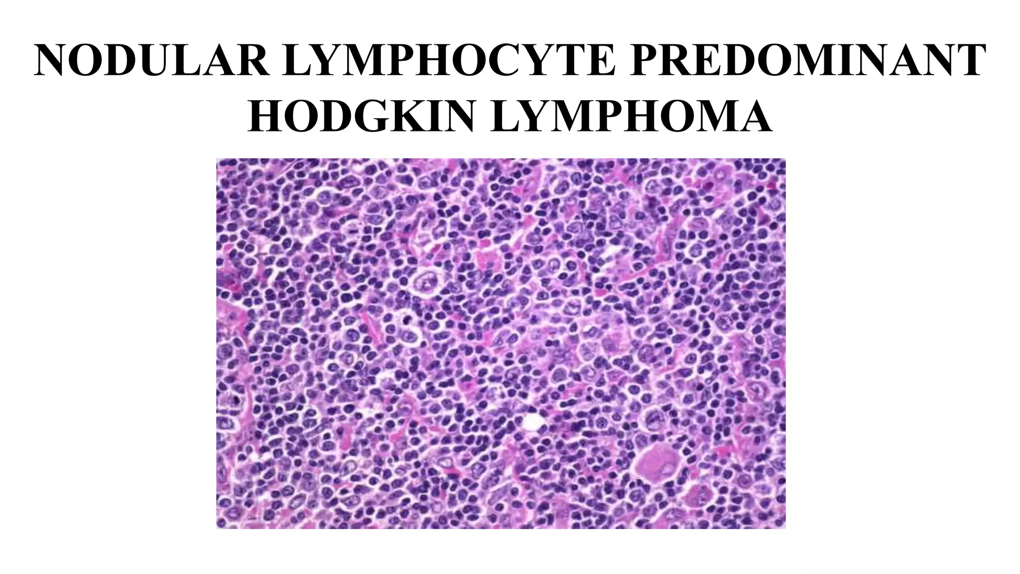Meghana - neoplastic lesions of lymph node - part 1 | PPT