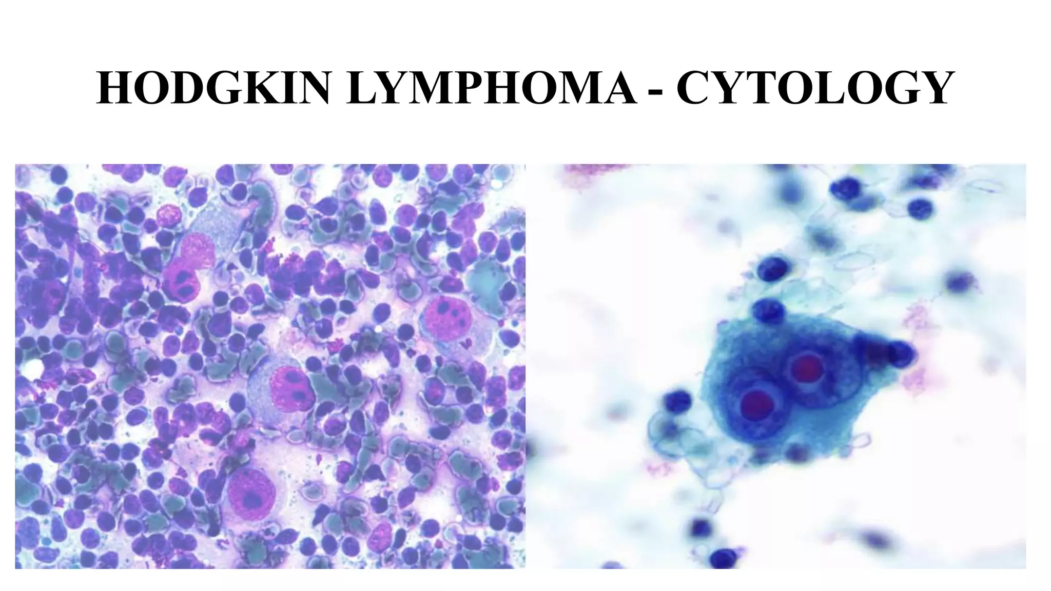 Meghana - neoplastic lesions of lymph node - part 1 | PPT