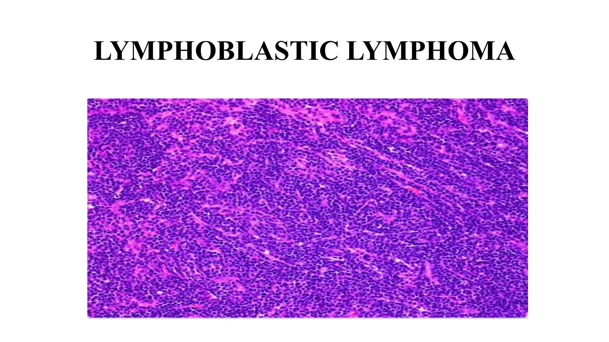 Meghana - neoplastic lesions of lymph node - part 1 | PPT