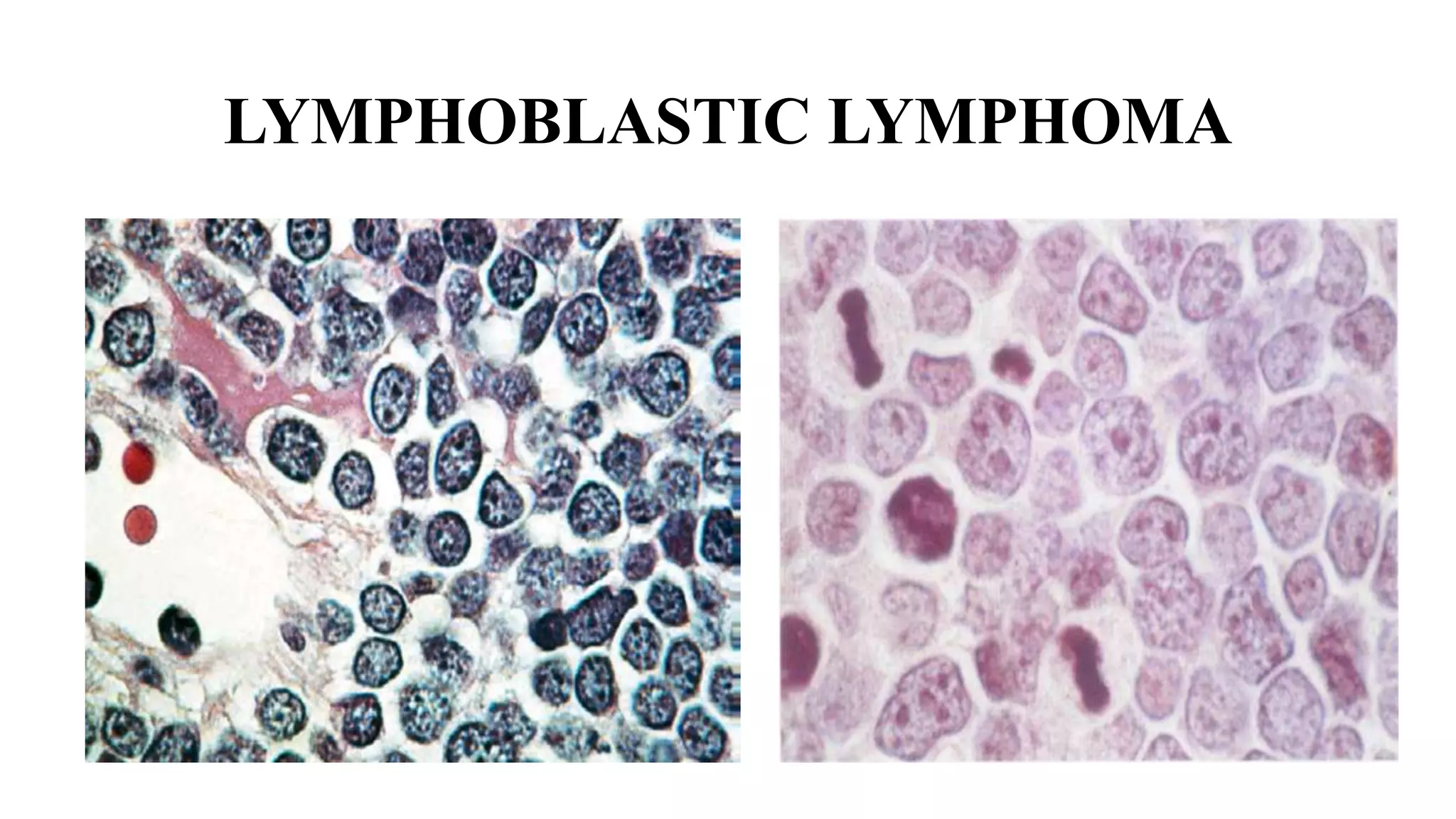 Meghana - neoplastic lesions of lymph node - part 1 | PPT