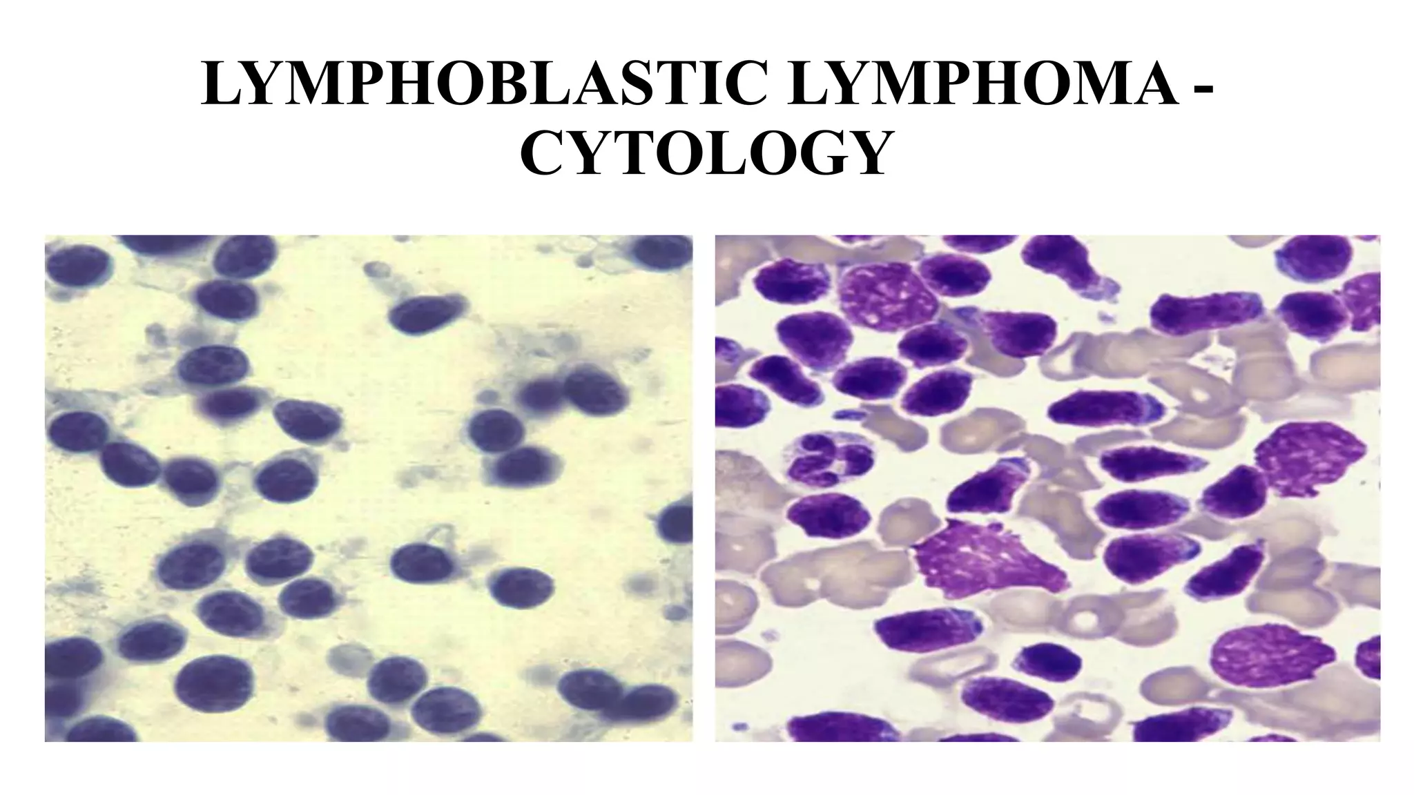 Meghana - neoplastic lesions of lymph node - part 1 | PPT