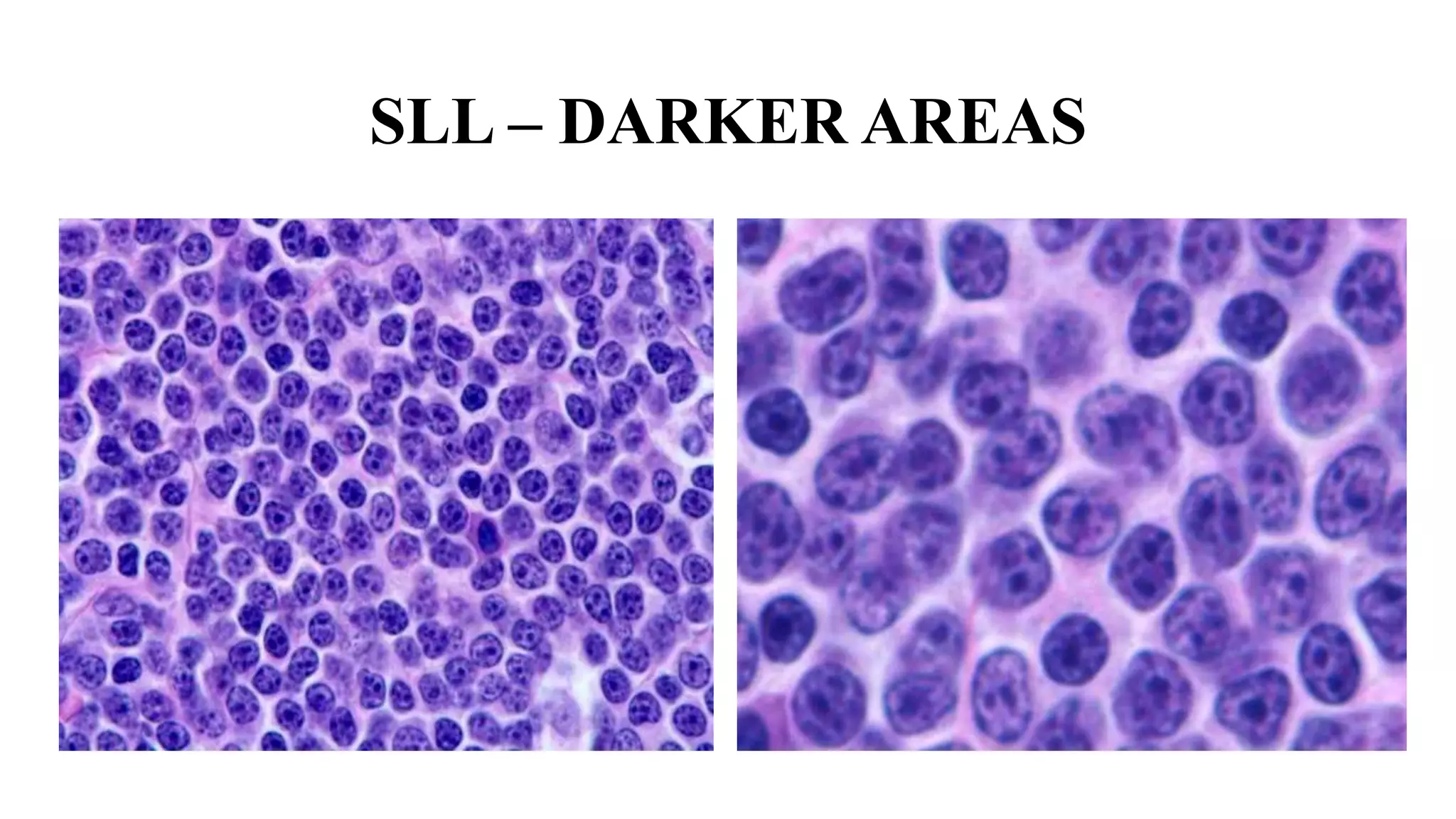 Meghana - neoplastic lesions of lymph node - part 1 | PPT