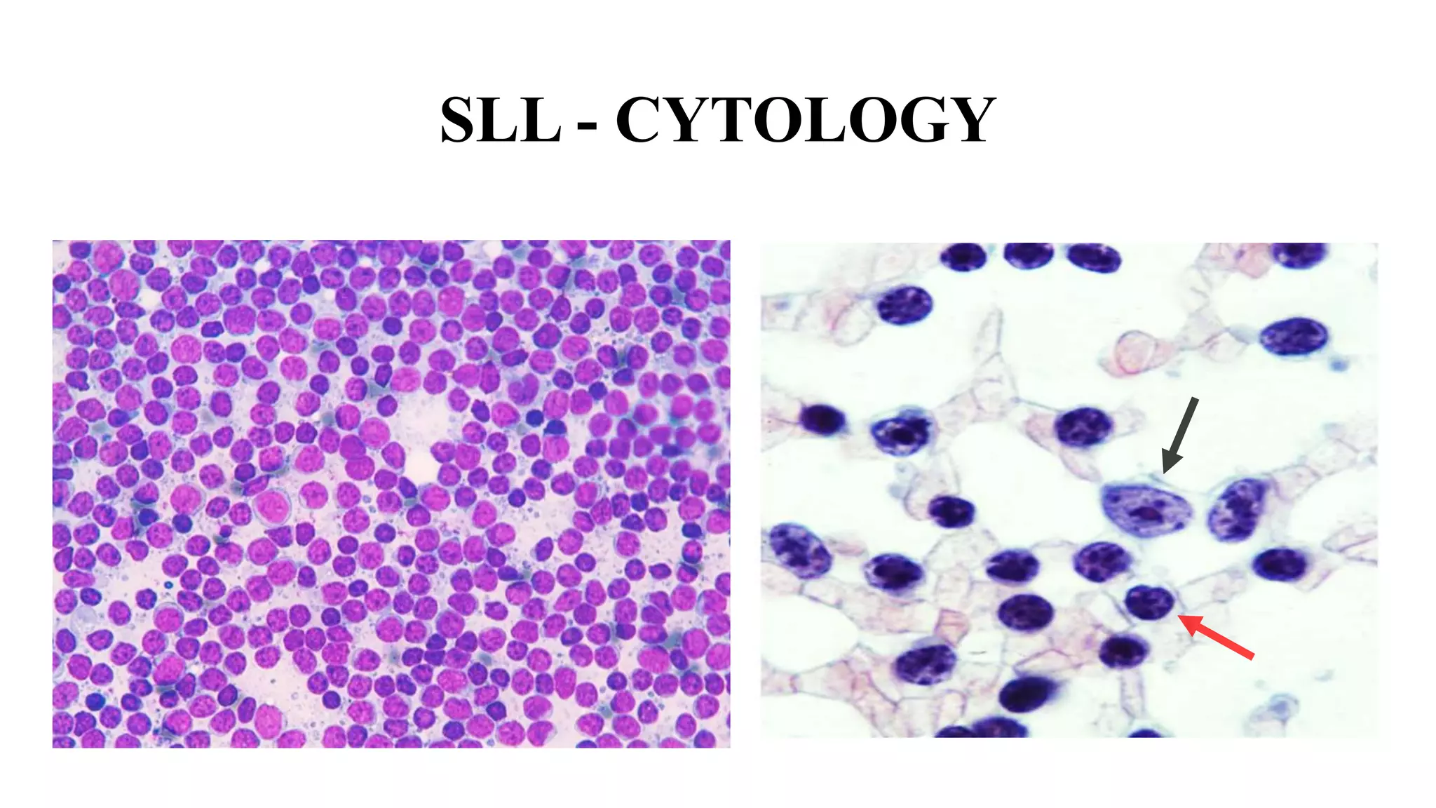 Meghana - neoplastic lesions of lymph node - part 1 | PPT