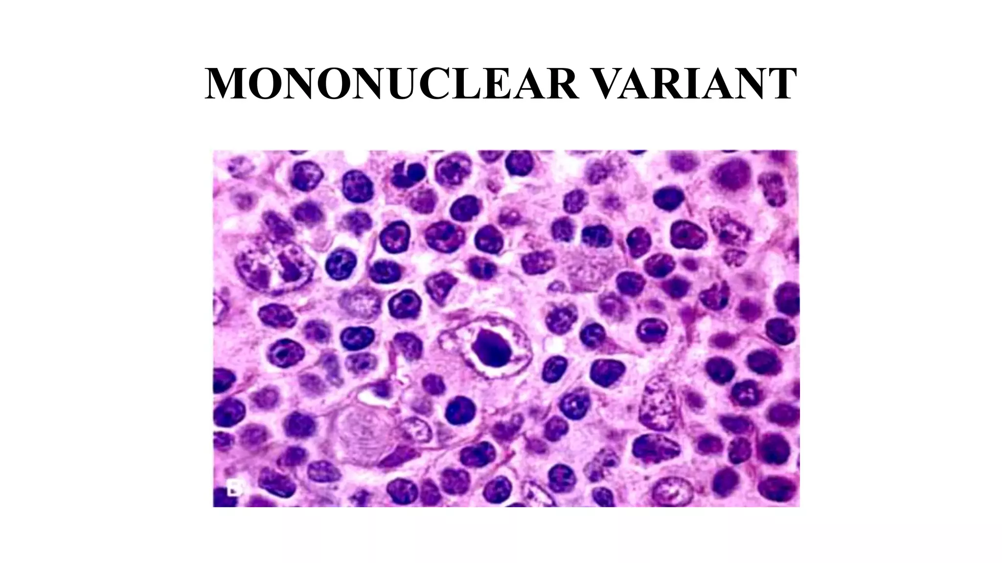 Meghana - neoplastic lesions of lymph node - part 1 | PPT