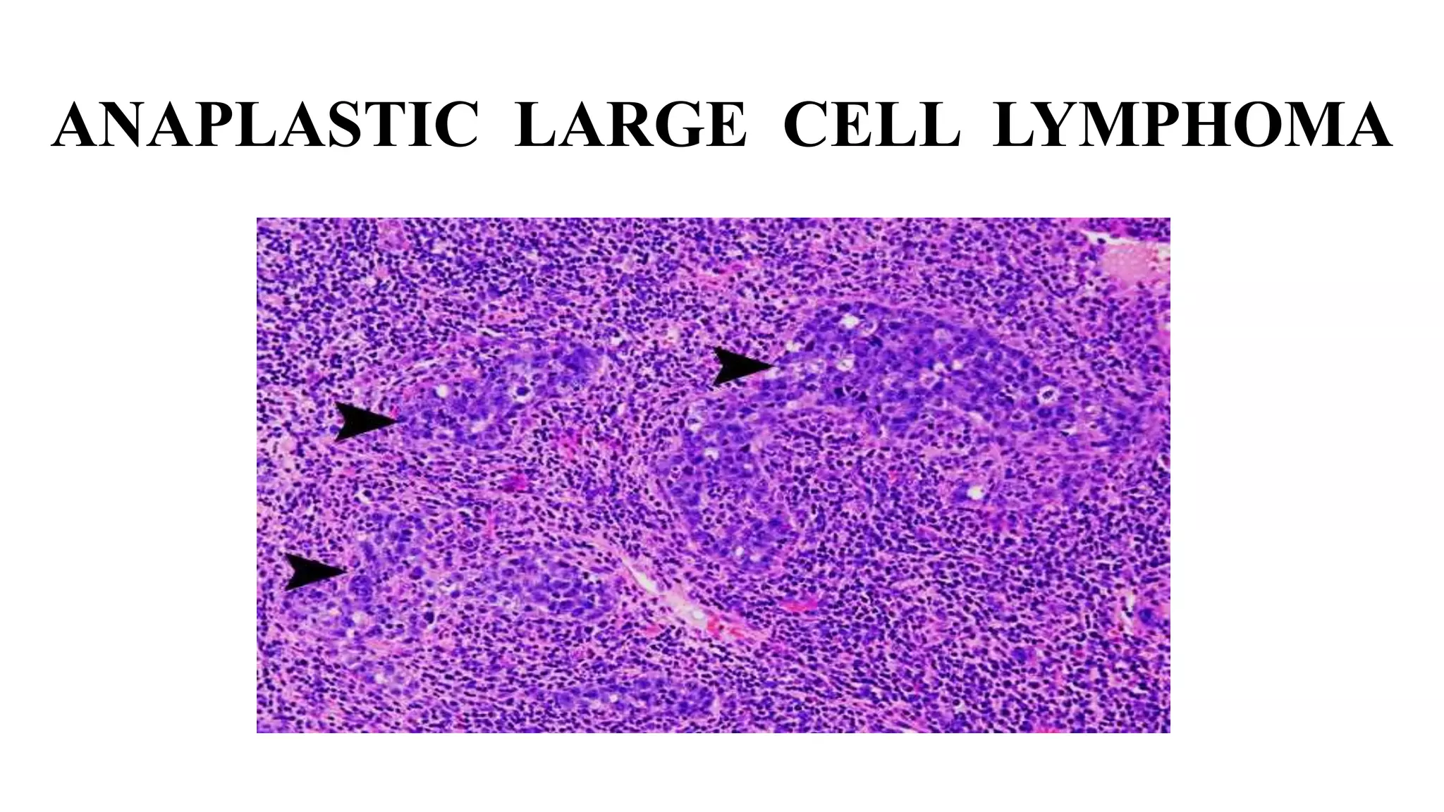 Meghana neoplastic lesions of lymph node - part 2 | PPTX | Cancer ...