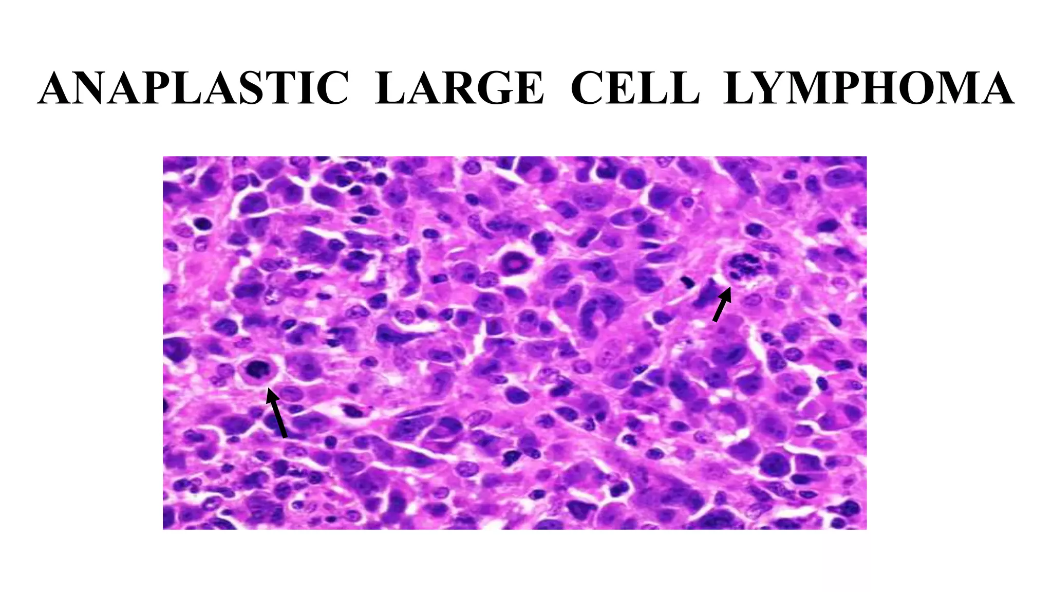 Meghana neoplastic lesions of lymph node - part 2 | PPTX | Cancer ...