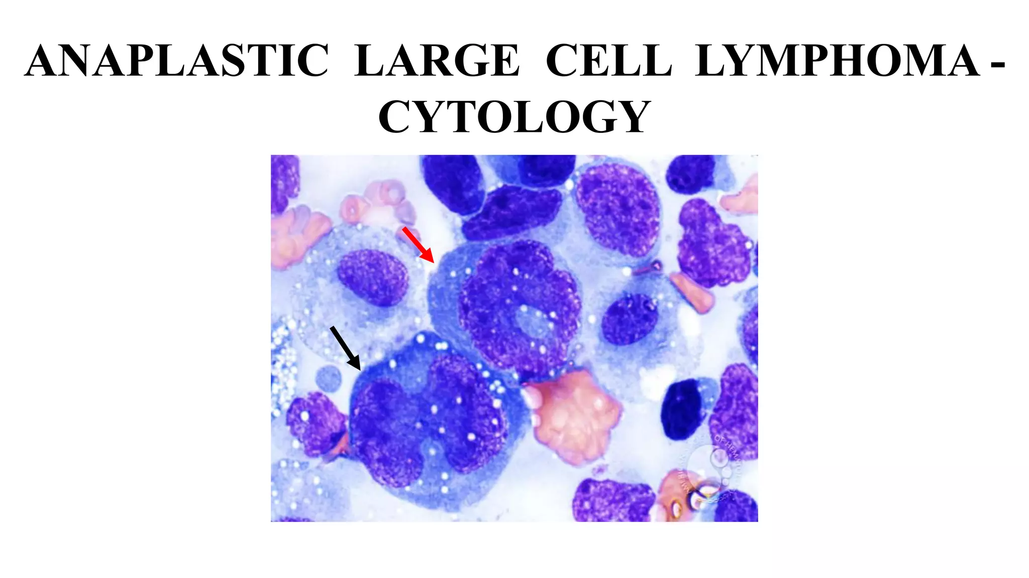 Meghana neoplastic lesions of lymph node - part 2 | PPTX | Cancer ...