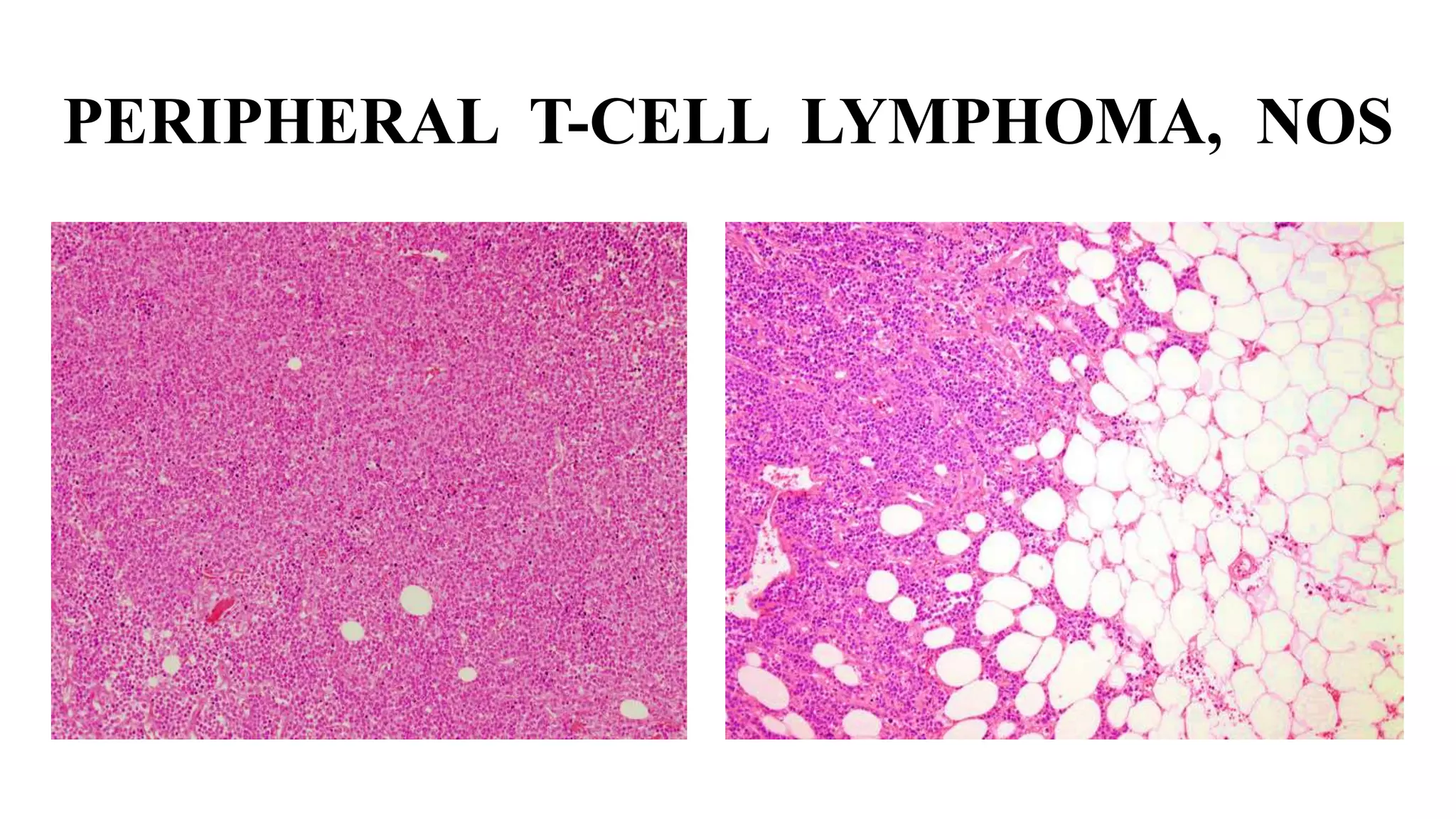 Meghana neoplastic lesions of lymph node - part 2 | PPTX | Cancer ...