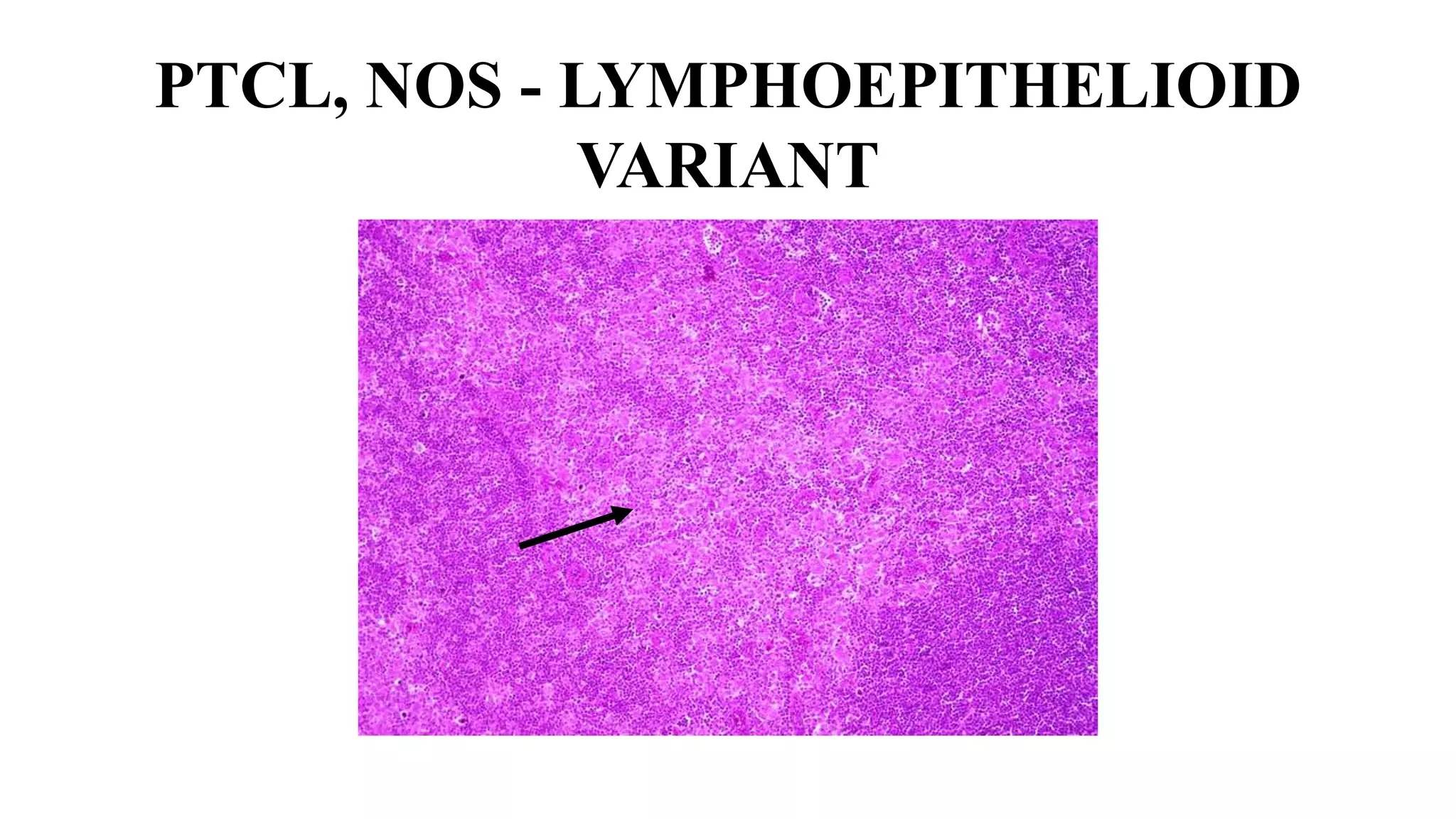 Meghana neoplastic lesions of lymph node - part 2 | PPTX | Cancer ...
