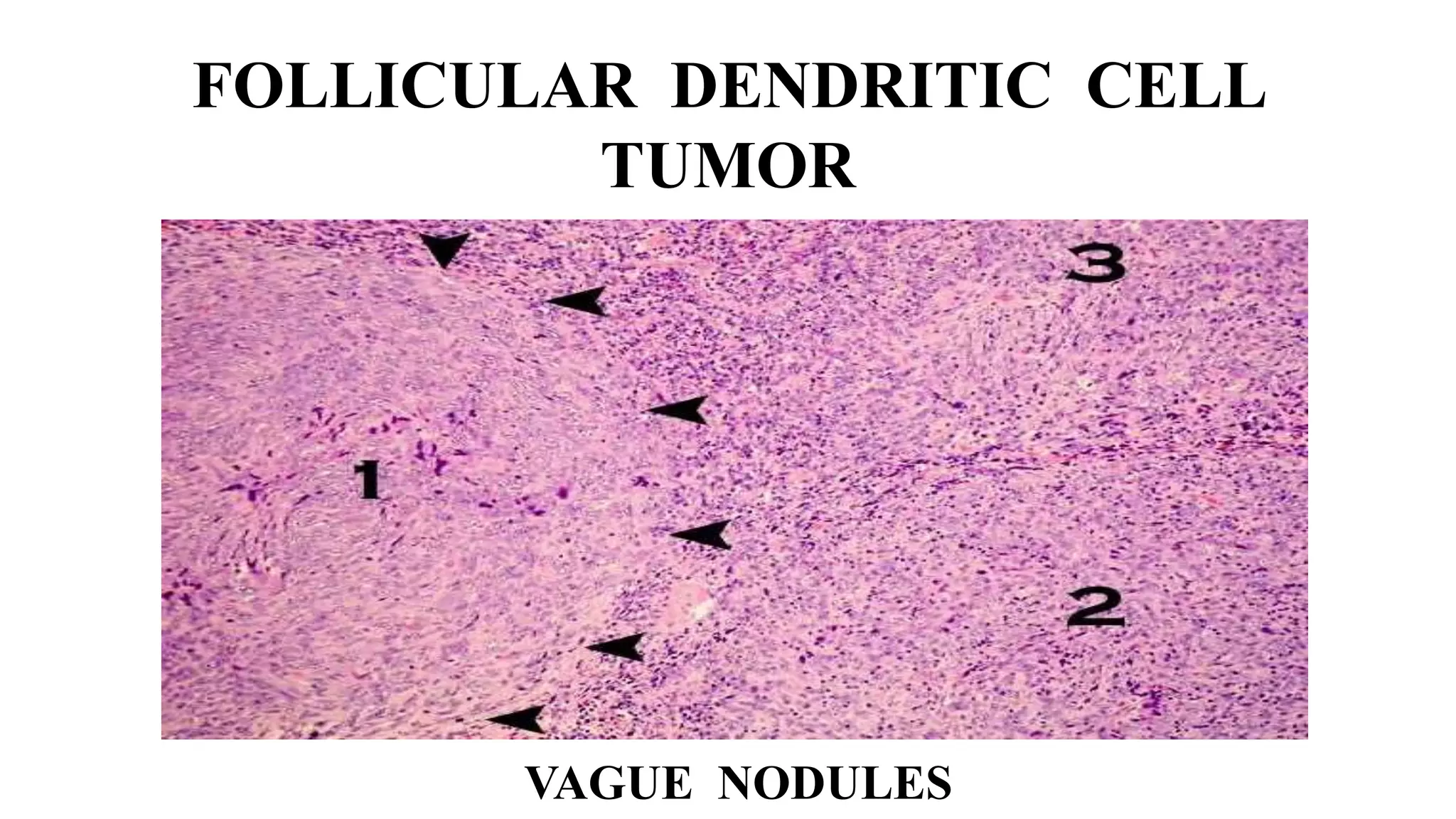 Meghana neoplastic lesions of lymph node - part 2 | PPTX | Cancer ...