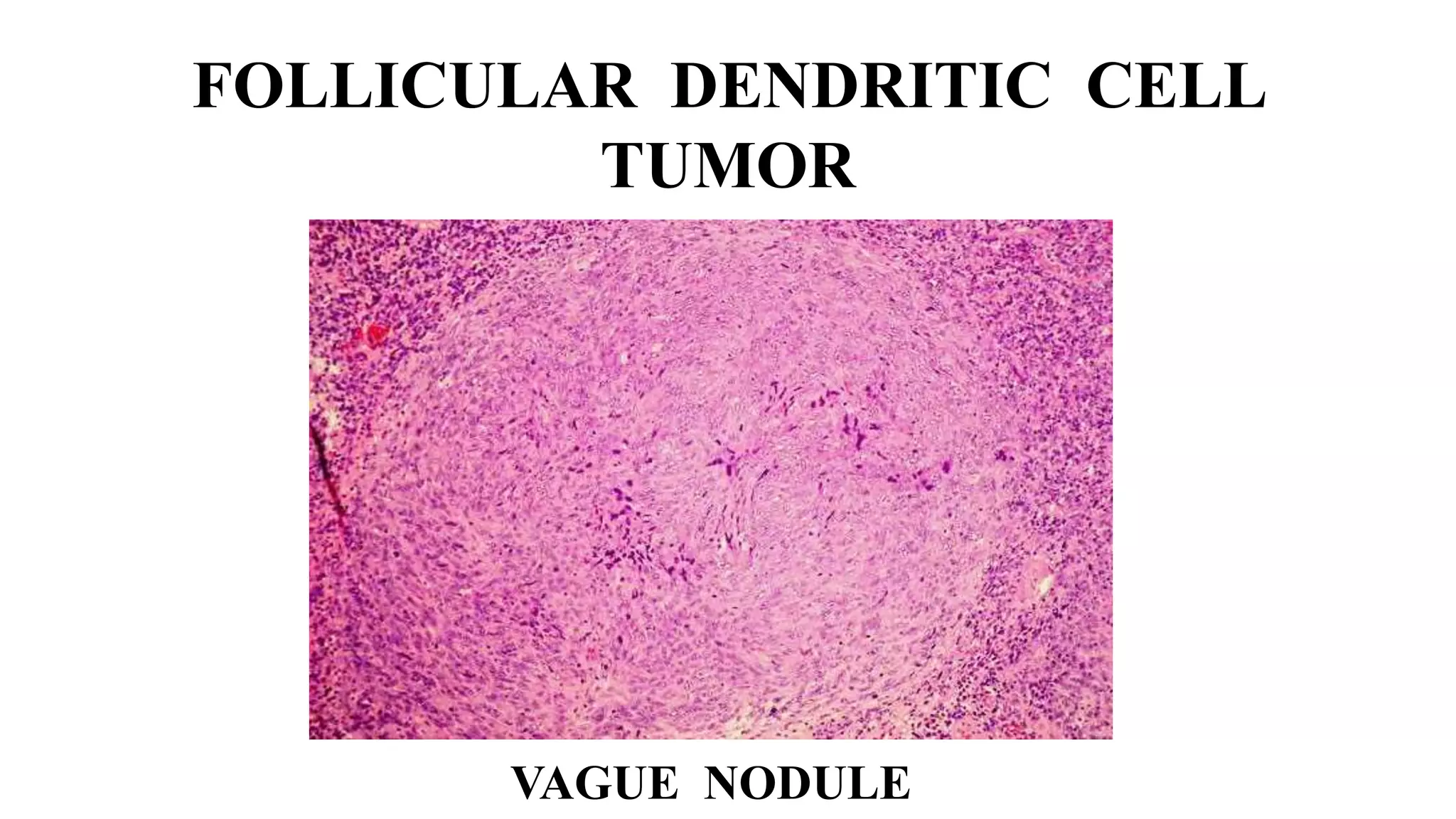 Meghana neoplastic lesions of lymph node - part 2 | PPTX | Cancer ...