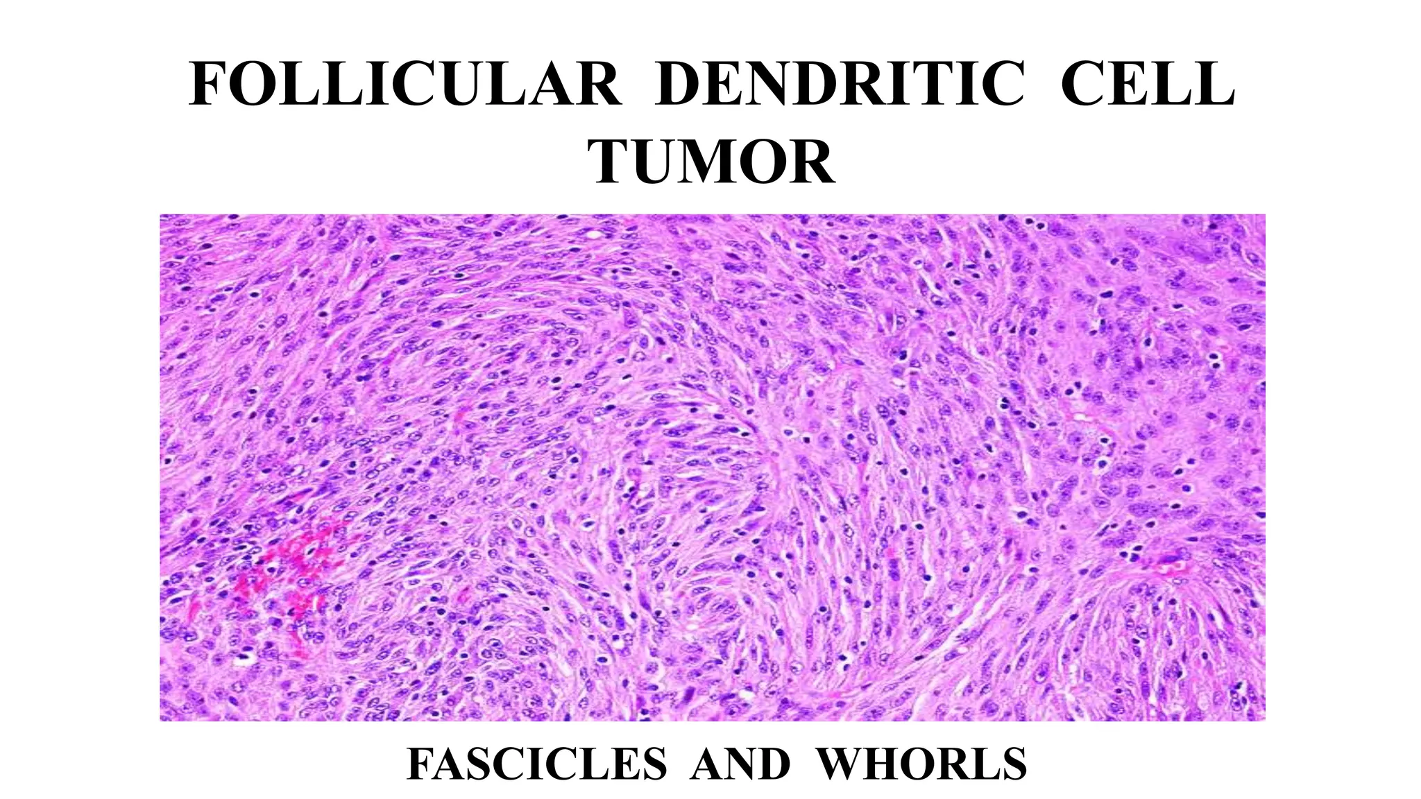 Meghana neoplastic lesions of lymph node - part 2 | PPTX | Cancer ...