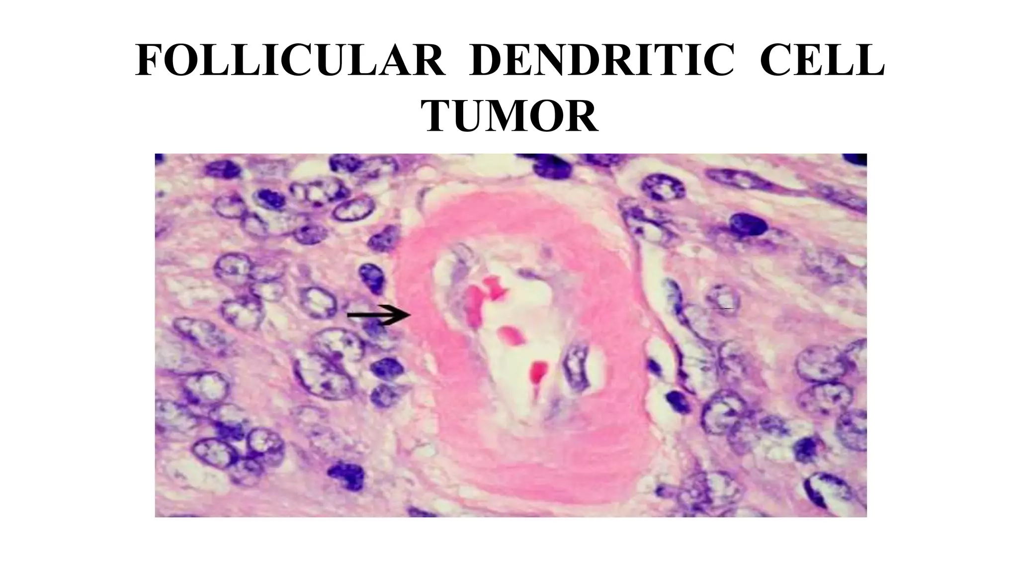 Meghana neoplastic lesions of lymph node - part 2 | PPTX | Cancer ...