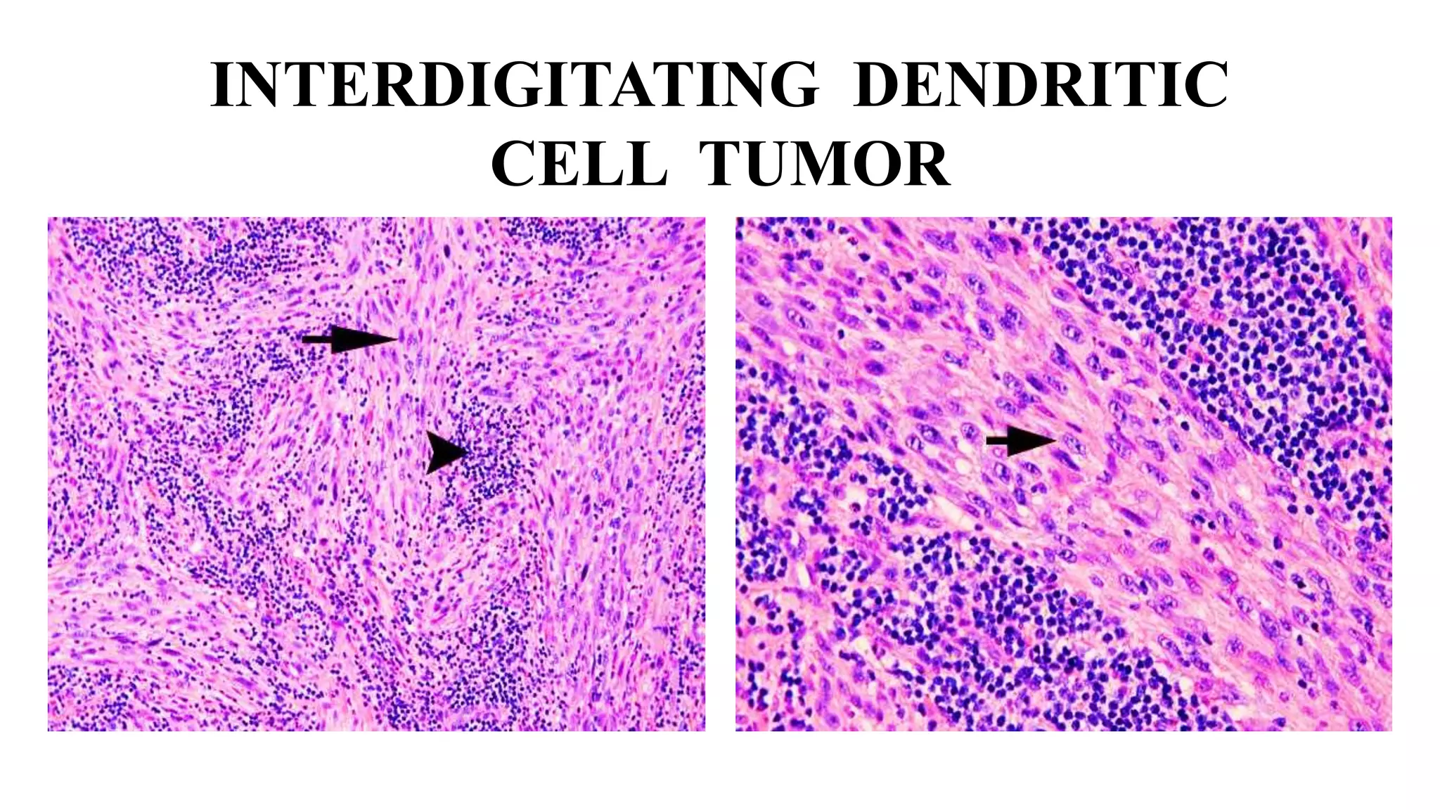 Meghana neoplastic lesions of lymph node - part 2 | PPTX | Cancer ...