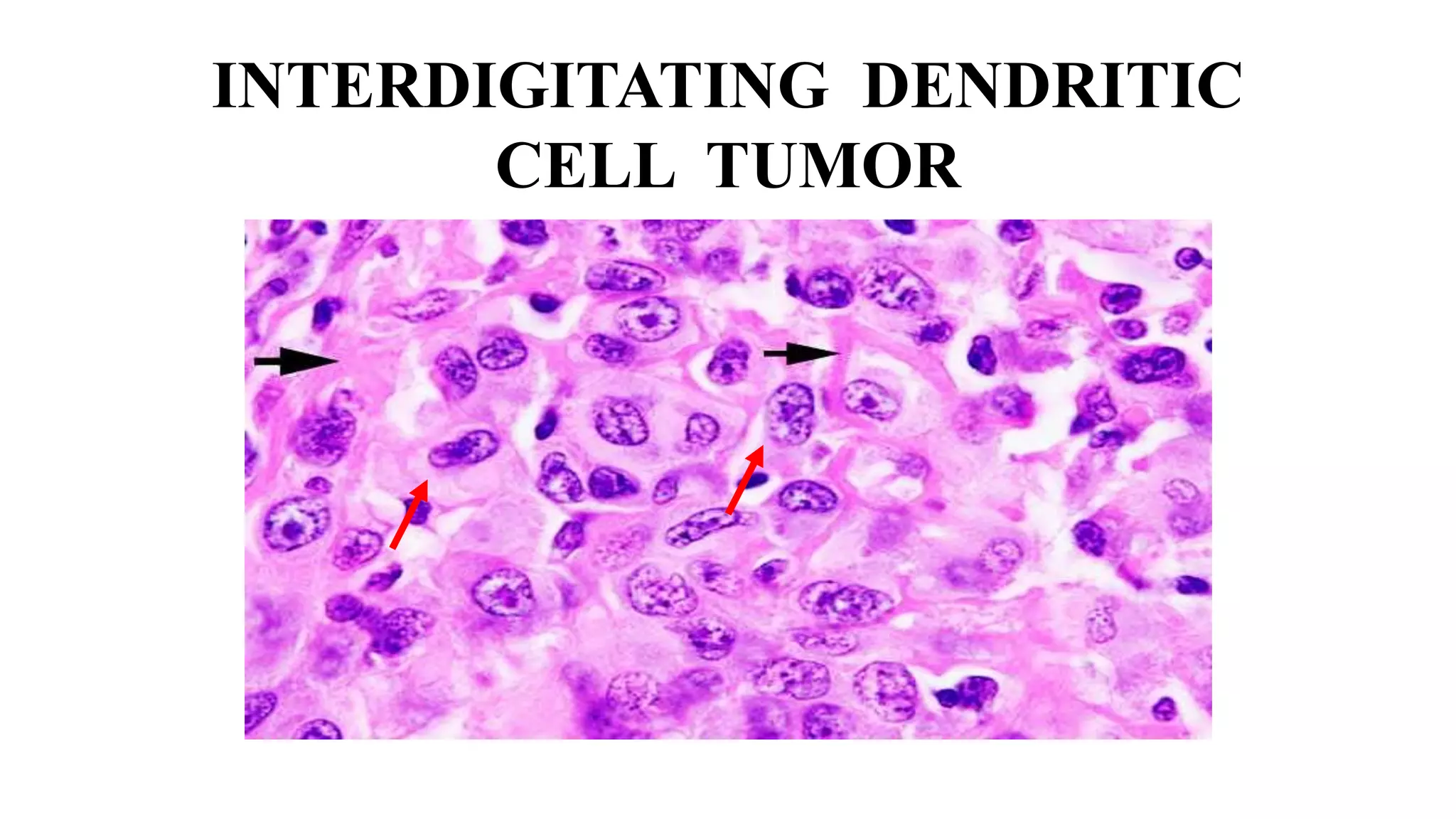 Meghana neoplastic lesions of lymph node - part 2 | PPTX | Cancer ...