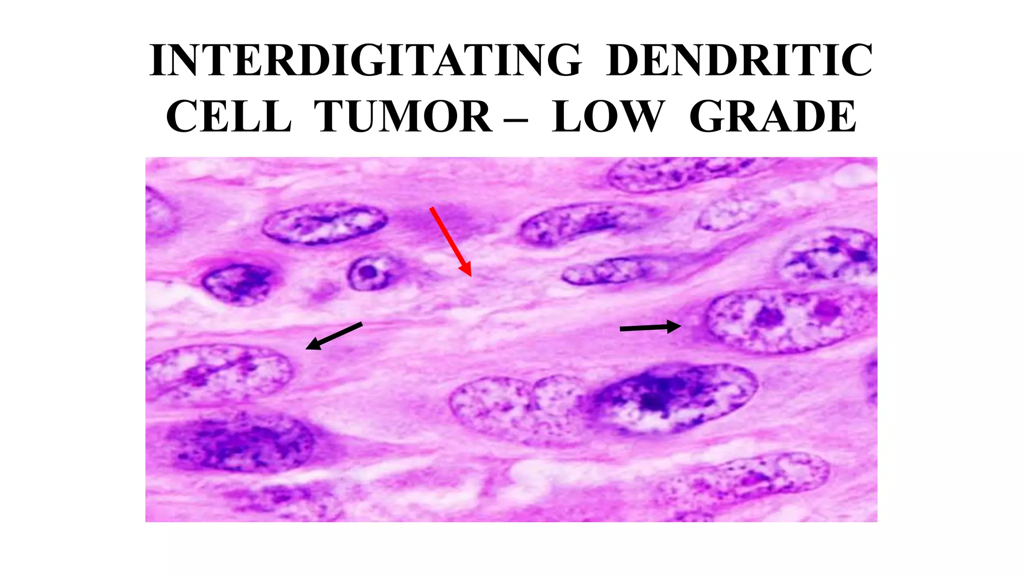 Meghana neoplastic lesions of lymph node - part 2 | PPTX | Cancer ...